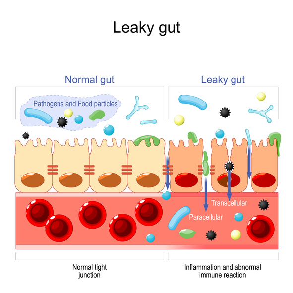 Postbiotics and Intestinal Permeability (Leaky Gut Syndrome ...
